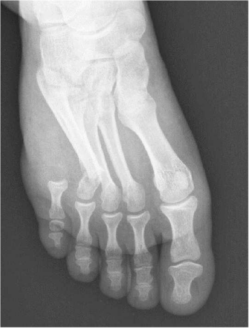 Dislocation Of Fifth Metatarsophalangeal Joint With An Adjacent