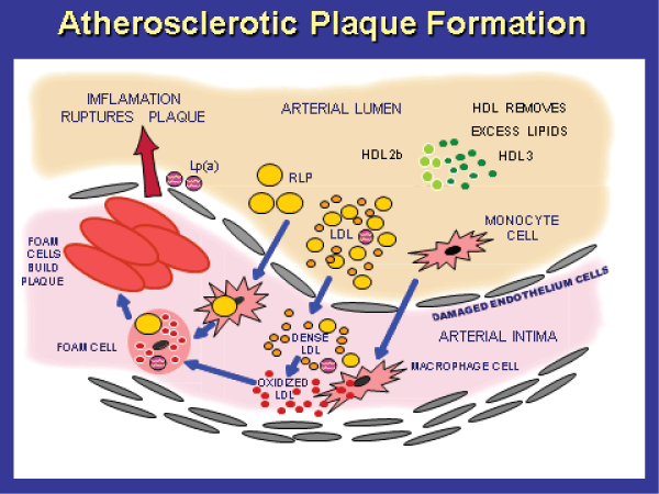 Atherosclerosis Plaque Formation