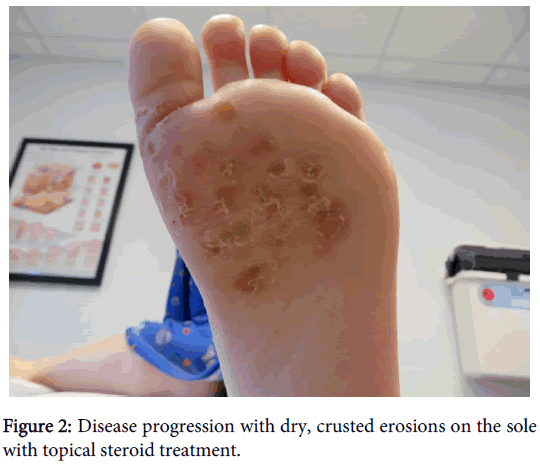 A Pediatric Case Of Bullous Tinea Pedis Caused By Trichophyton