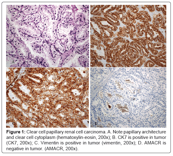 Cytology Histology Clear Cell Papillary