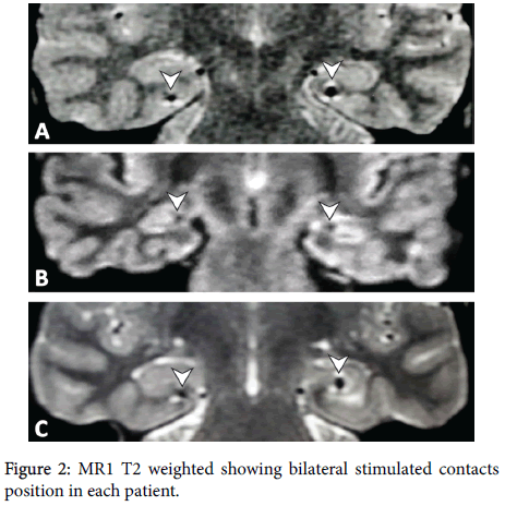 Temporal Lobe Epilepsy In Patients With Nonlesional Mri