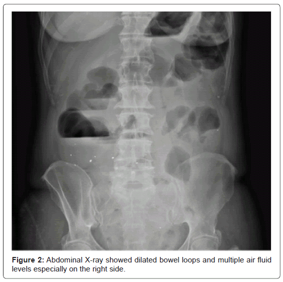 Case Report Clozapine Induced Ogilvies Syndrome Omics International