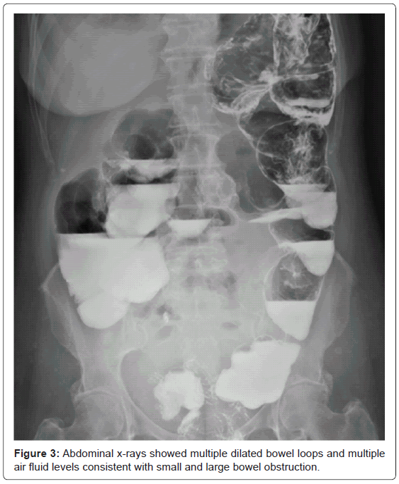 Case Report Clozapine Induced Ogilvies Syndrome Omics International