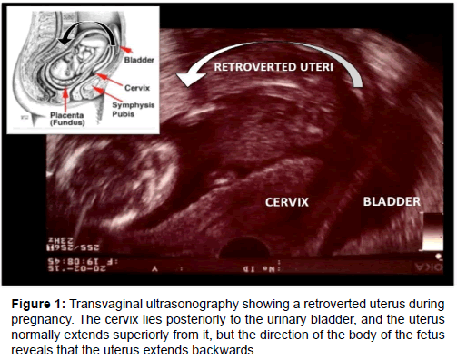 Retroverted Retroflexed Uterus Ultrasound
