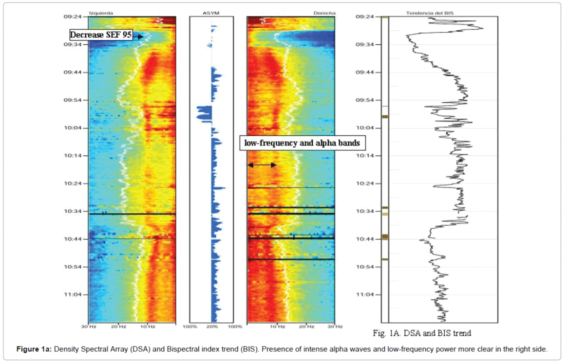 neurorehabilitation-Density-Spectral-Array