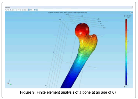 osteoporosis-and-physical-activity-element-analysis-bone
