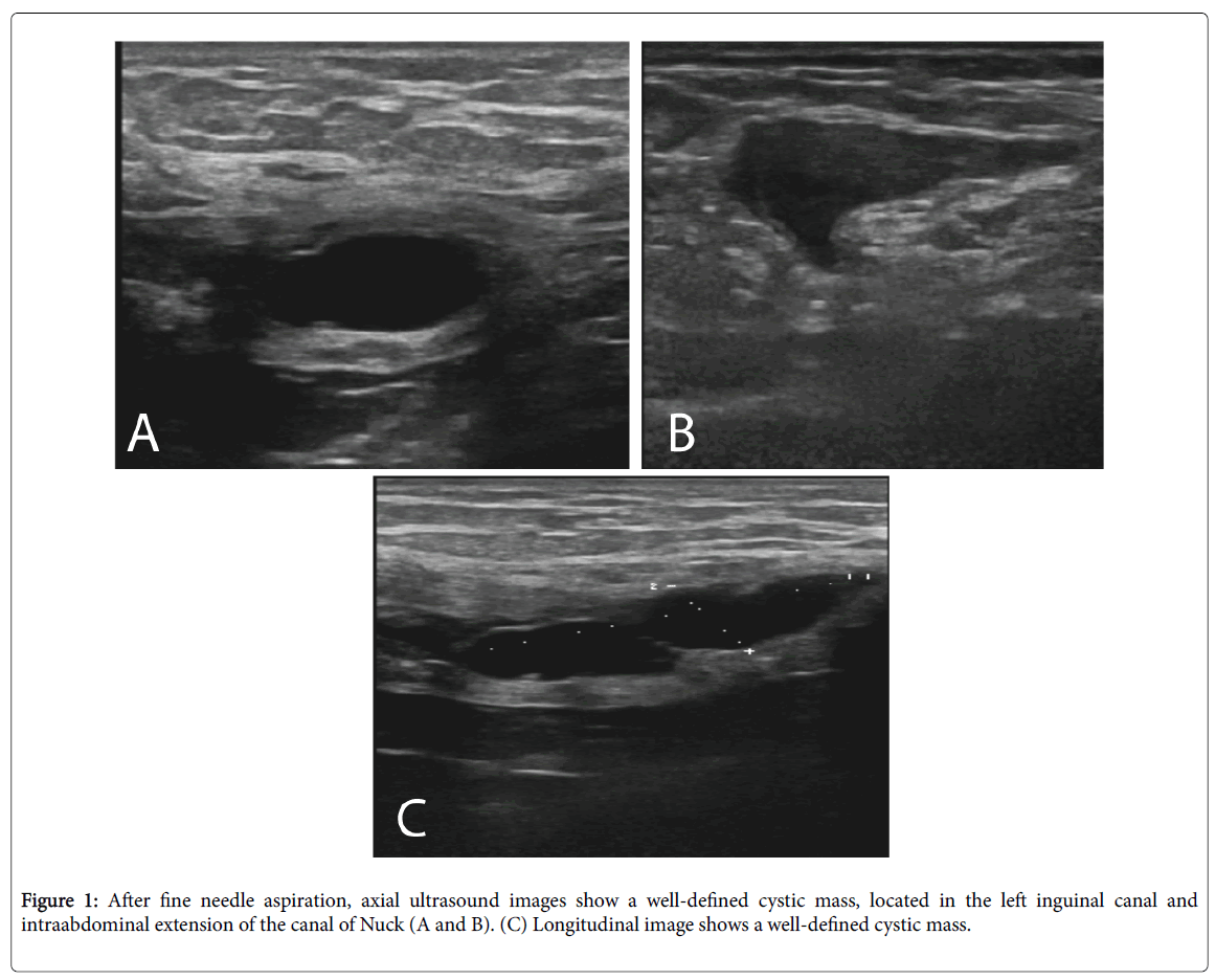 Radiology Needle Aspiration