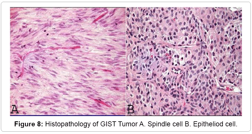 surgery-Histopathology-GIST