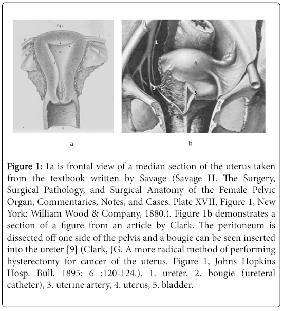 Cardinal Ligament Uterus Anatomy