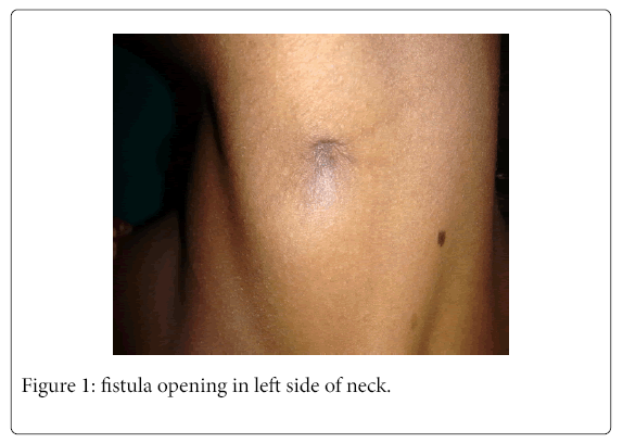 Thyroglossal Cyst And Fistula Surgical Pitfalls And Causes Of Images