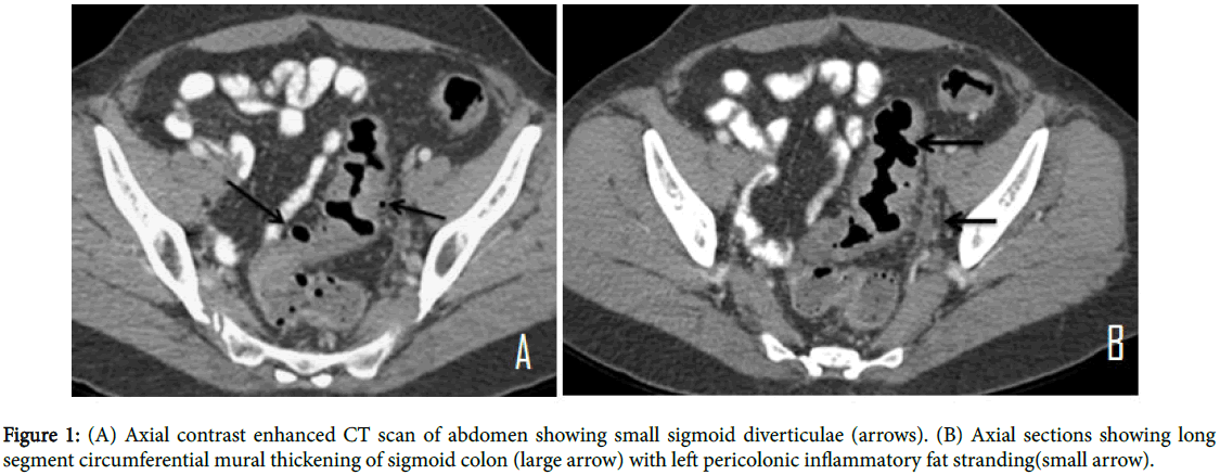 Journal Of Radiology Colosalpingeal Fistula Rare Complication Of Sigmoid Diverticulitis